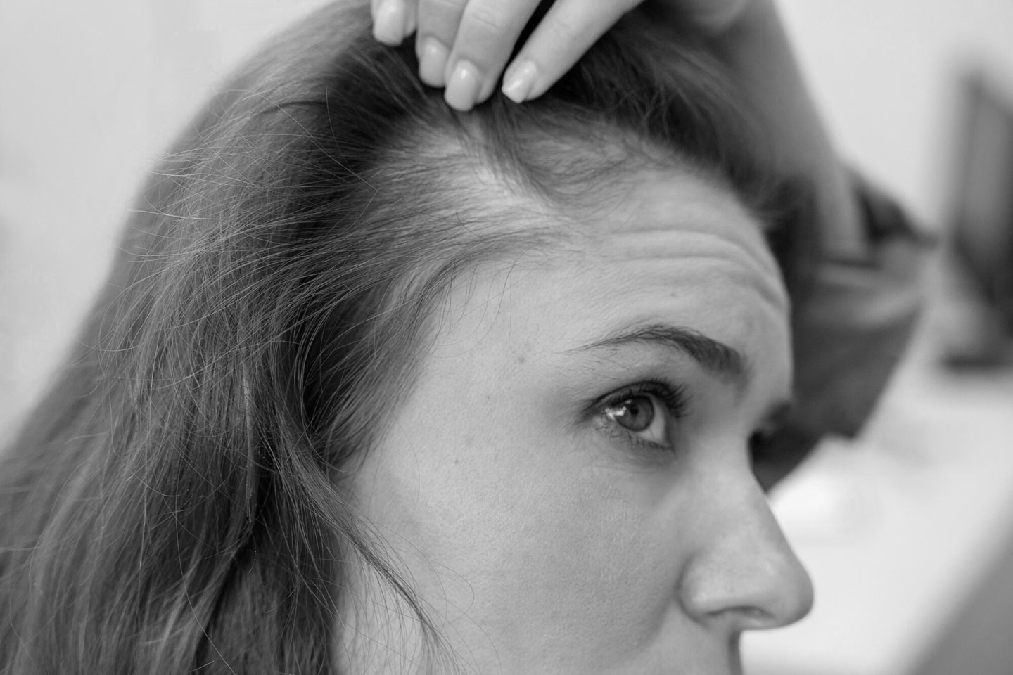 Scarring Alopecia: Causes, Symptoms and Treatment